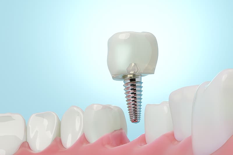 Single Tooth Implants - Couzens Dental
